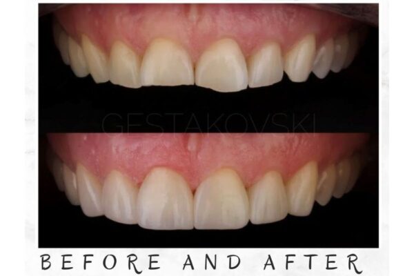 Are Injectable Veneers Right For You? | Sala Family Dentistry