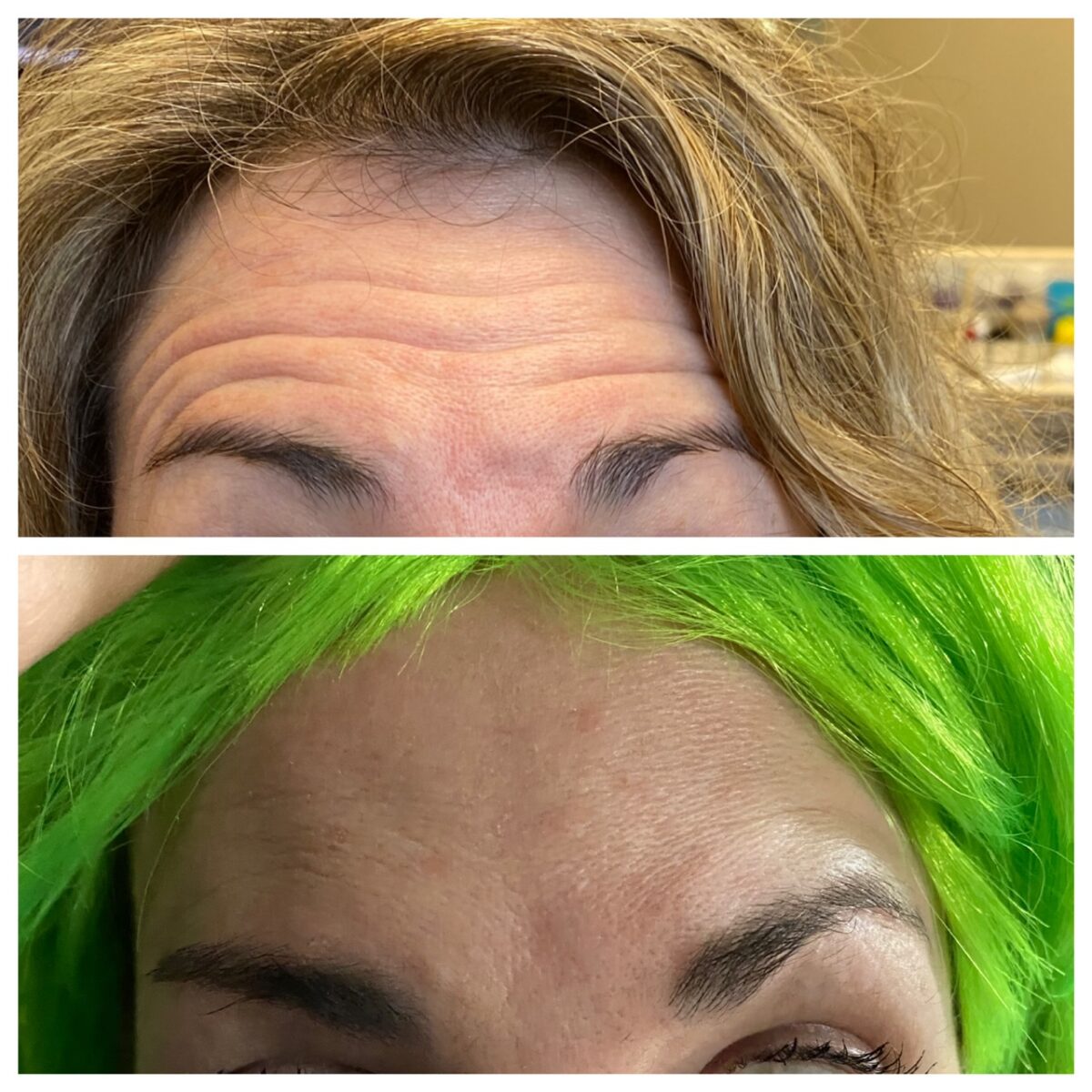 Botox® in Reno, NV | Reno Dentists | Sala Family Dentistry