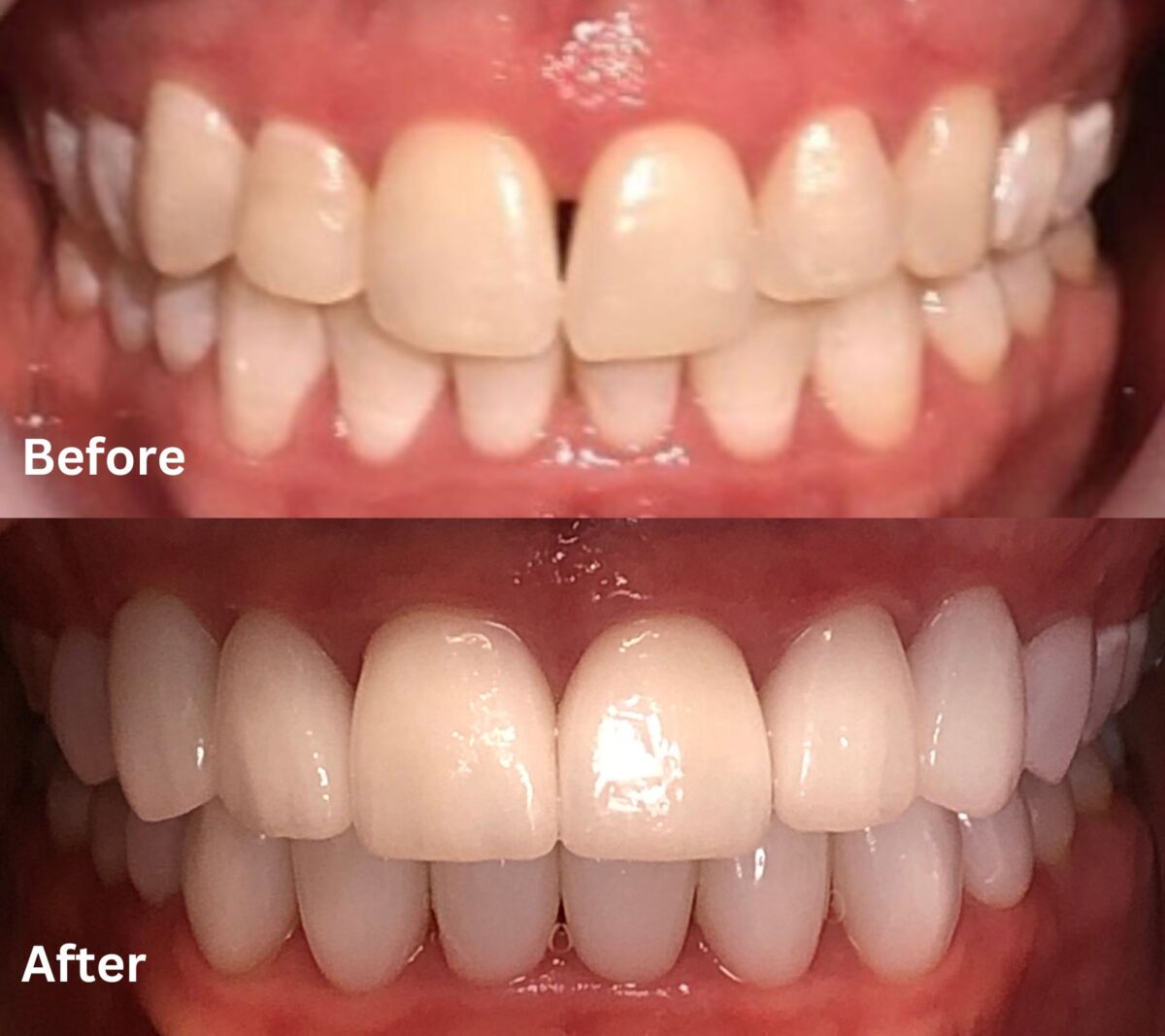Invisalign Before & After | Sala Family Dentistry